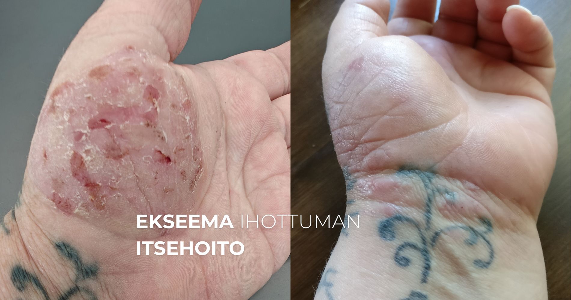 Ekseema ja eri ihottumat kuvina sekä ekseema ihottuman kotihoito ...