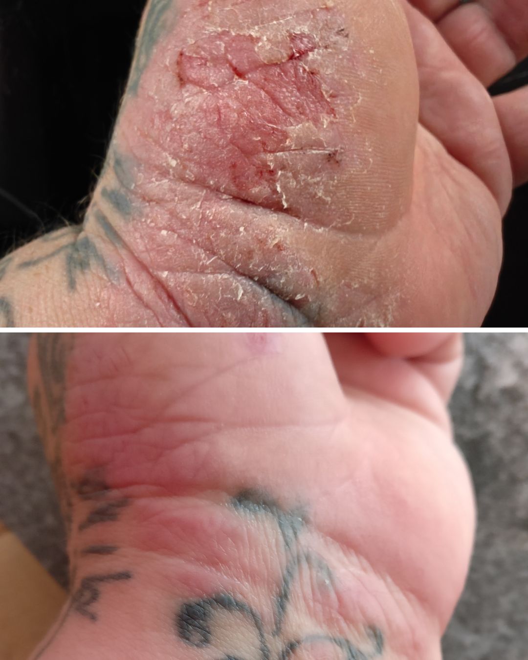 Ekseema ja eri ihottumat kuvina sekä ekseema ihottuman kotihoito ...